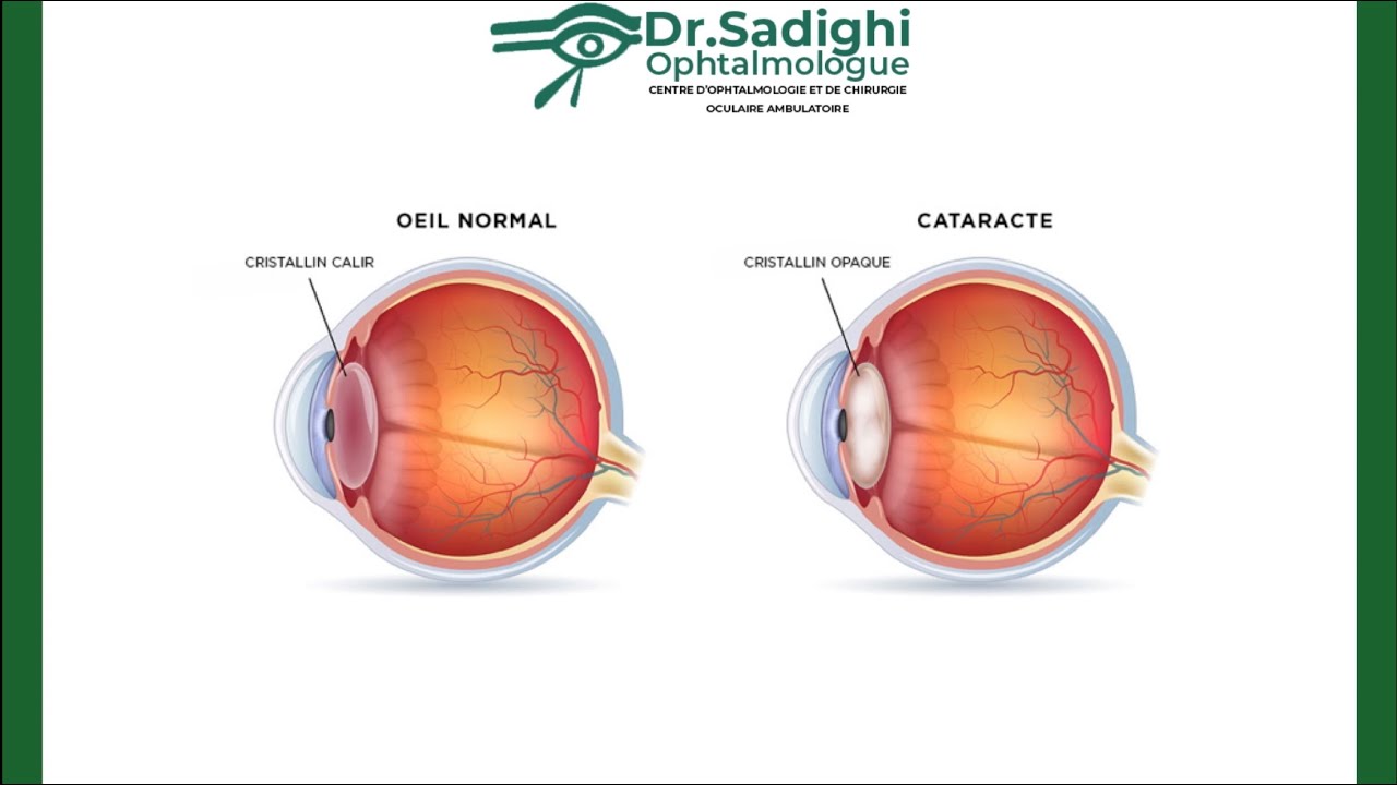Qu'est ce que la cataracte ? • Dr.SADIGHI - YouTube