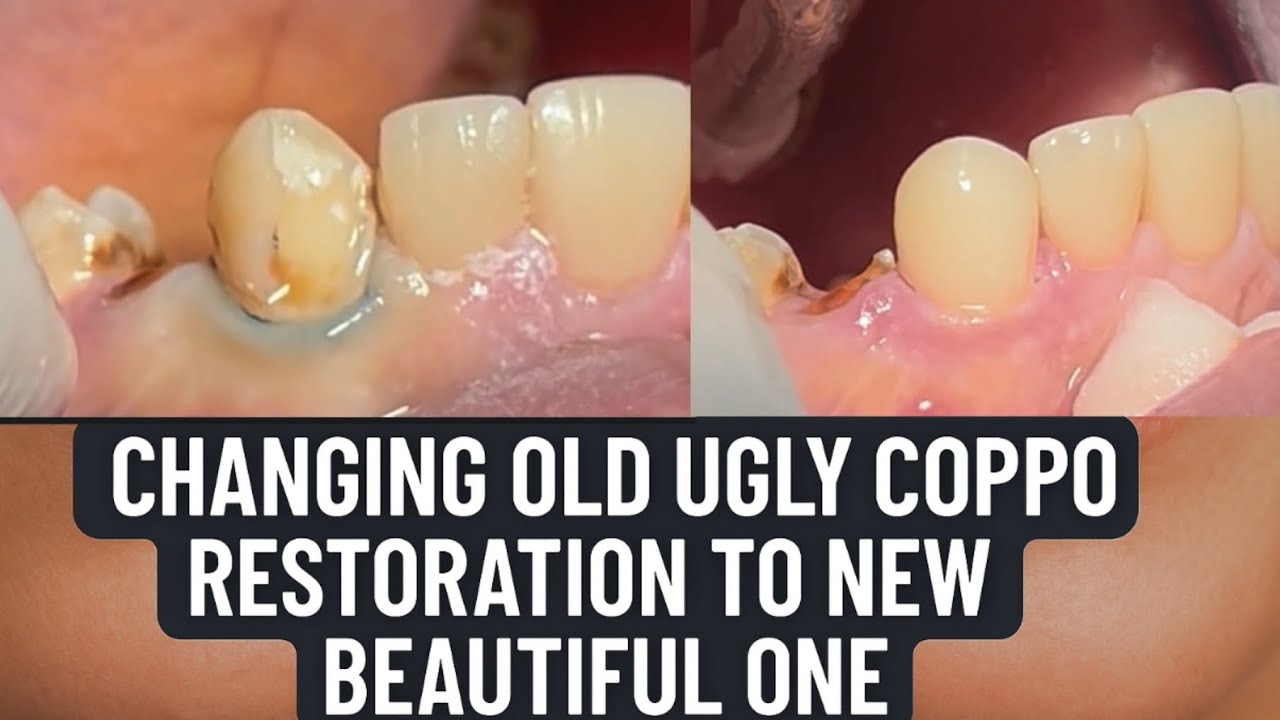 Change Old Bad Composite restoration - YouTube