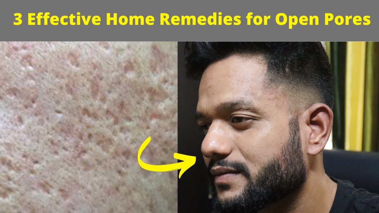 How to Get Rid of Open Pores on Face & Skin Naturally | 3 Effective ...