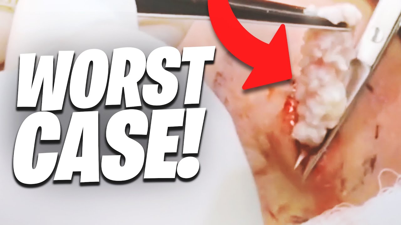 Dr. Pimple Popper's WORST CASES!🤮 - YouTube
