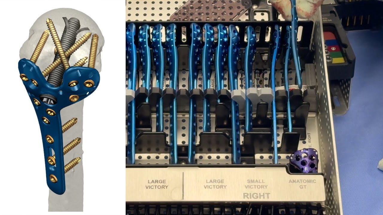 Repair of Proximal Humerus Fracture with the Exactech "Victory Plate ...