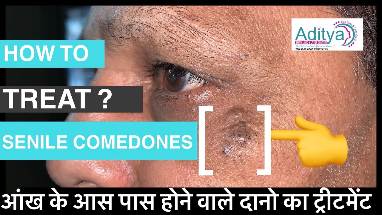 SENILE COMEDONES | आंख के आस पास होने वाले दानो का ट्रीटमेंट कैसे होता ...