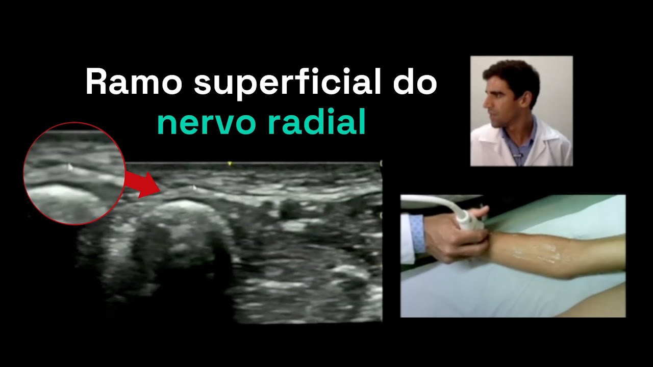 Ramo superficial do nervo radial: é possível ao ultrassom? - YouTube