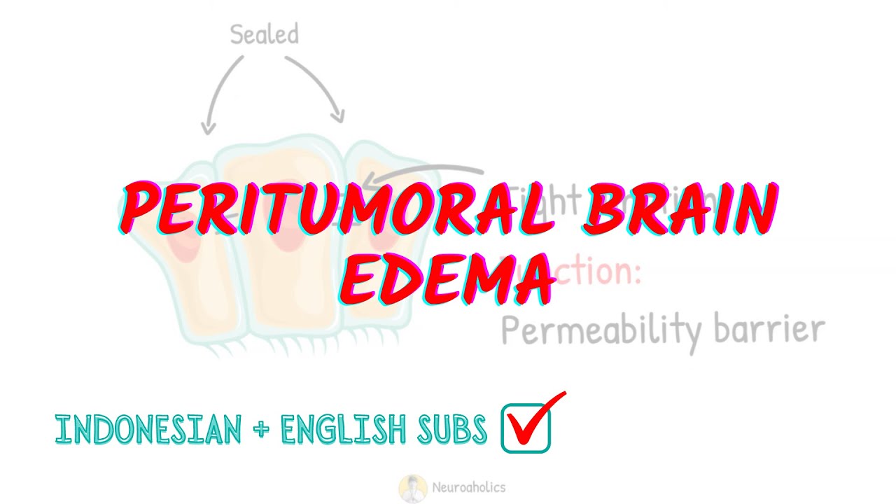 Peritumoral brain edema | a type of vasogenic cerebral edema ...