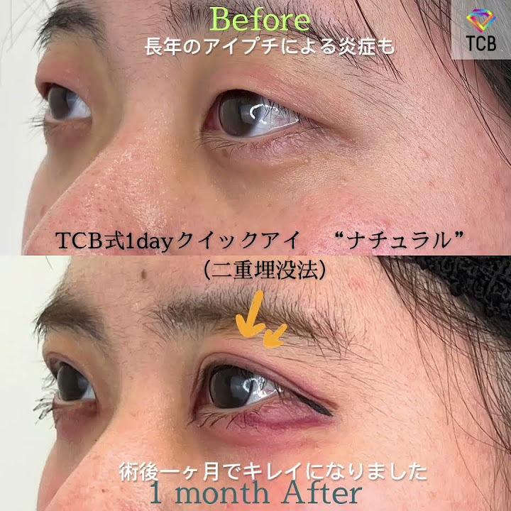 【TCB式1dayクイックアイ（二重埋没法）】#shorts - YouTube