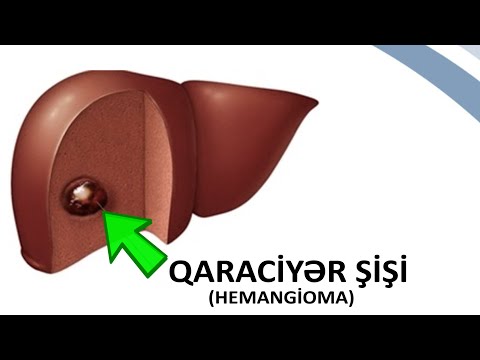 Hamiləlikdən qoruyan dərmanlar - Qaraciyərdə şiş yaradır?