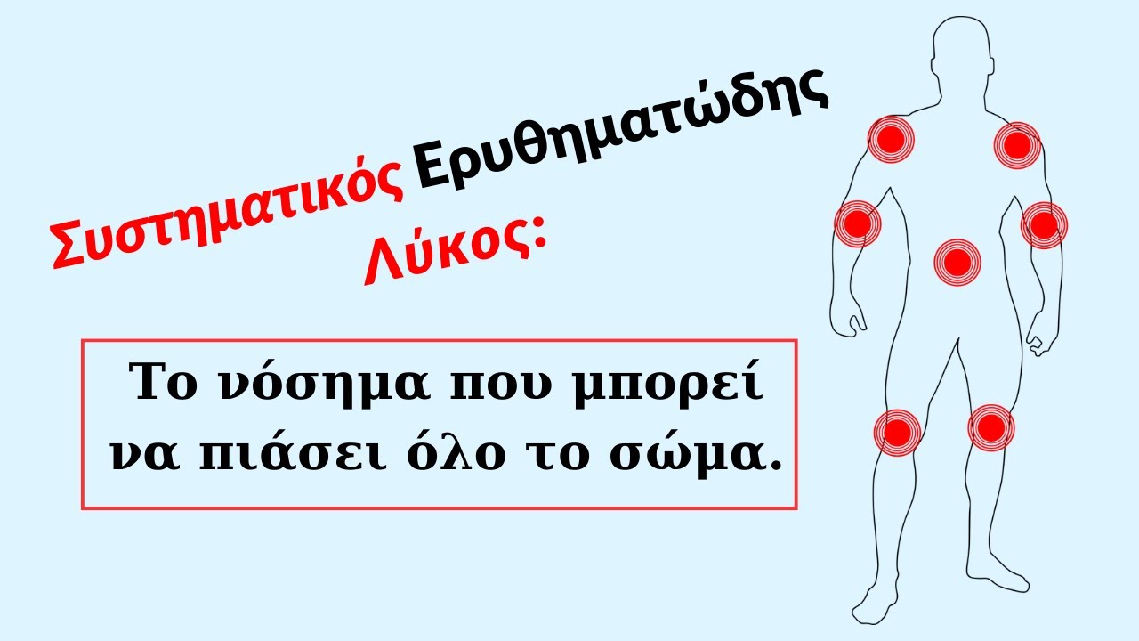 Συστηματικός Ερυθηματώδης Λύκος: Συμπτώματα και διάγνωση - YouTube