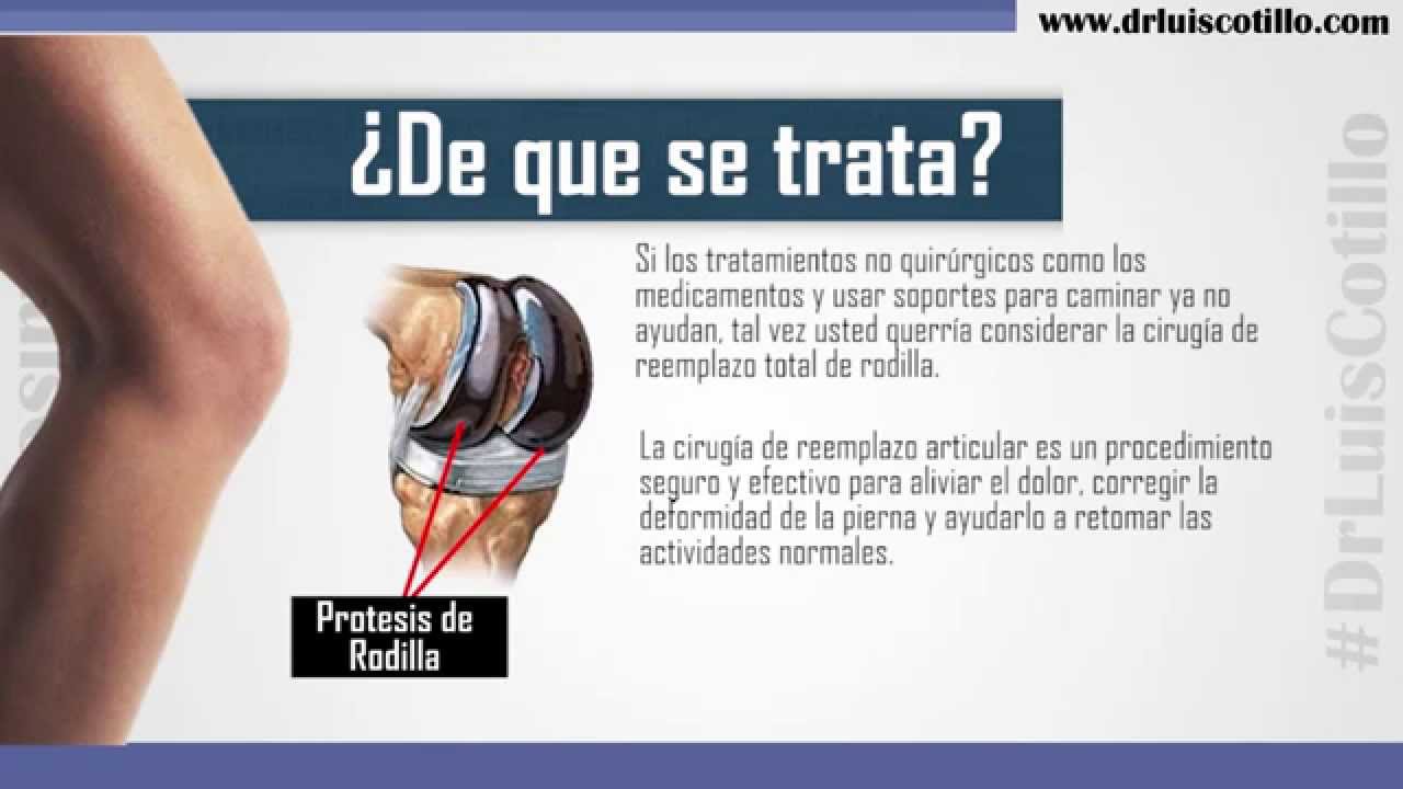 Dr. Luis Cotillo - Vídeo Informativo; "PRÓTESIS DE RODILLA" - YouTube