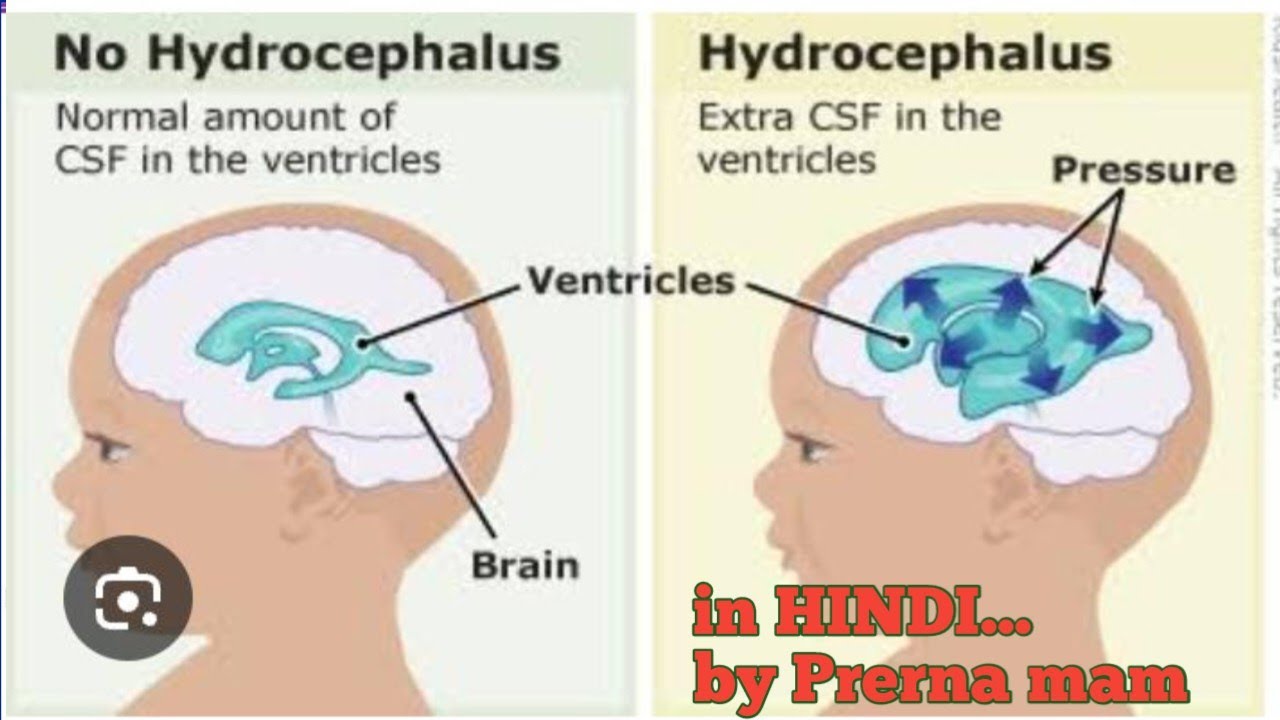 HYDROCEPHALUS|Definition,Diagnostic evolution,Symptoms,Medical ...