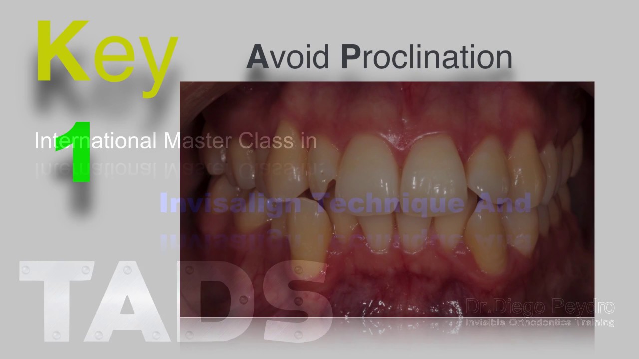 Invisalign and TADS. How to avoid proclination - YouTube