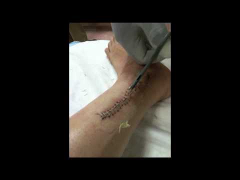 Removing staples from my leg - YouTube