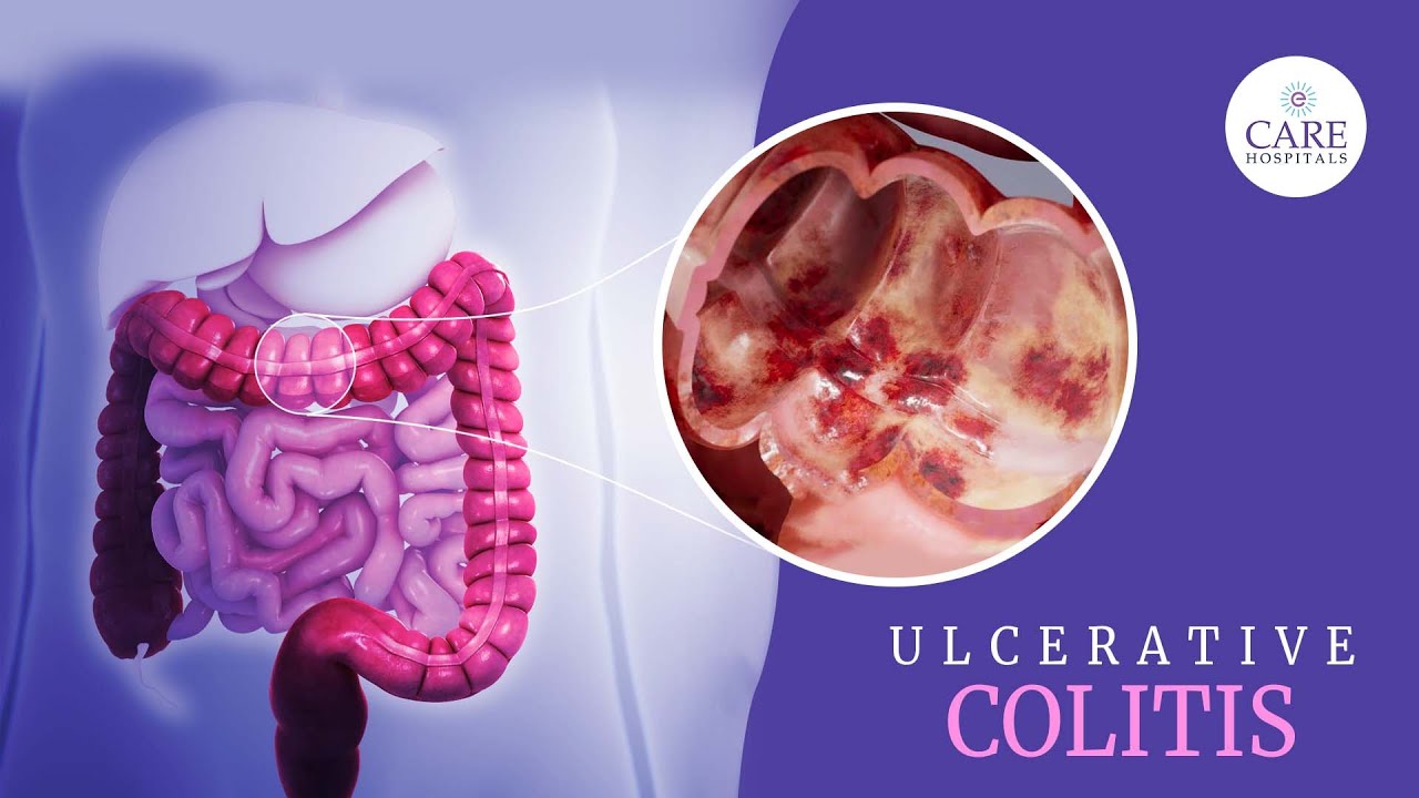 What is Ulcerative Colitis? Causes, Symptoms, Diagnosis, Treatment for ...