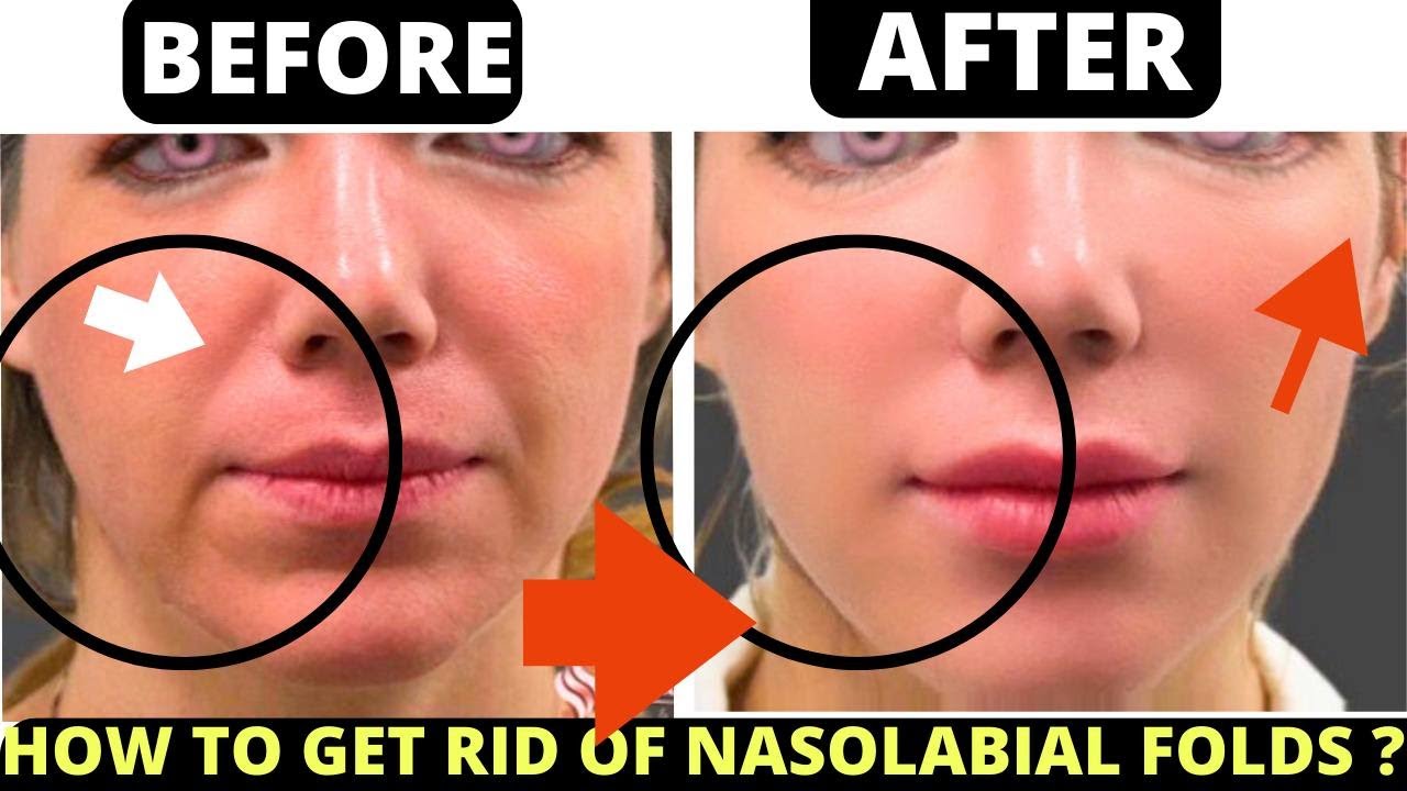 HOW TO GET RID OF NASOLABIAL FOLDS ? LAUGH LINES, SMILE LINES | FACE ...