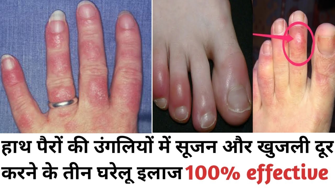 ठंड में हाथ पैरो की उंगलियो में सूजन व खुजली के घरेलू इलाज,hatho me ...