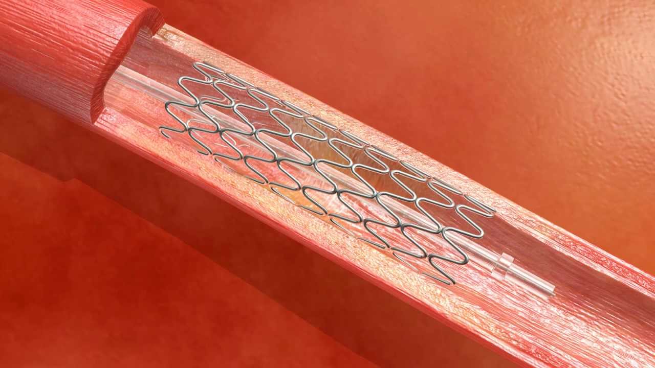 STENTING - YouTube