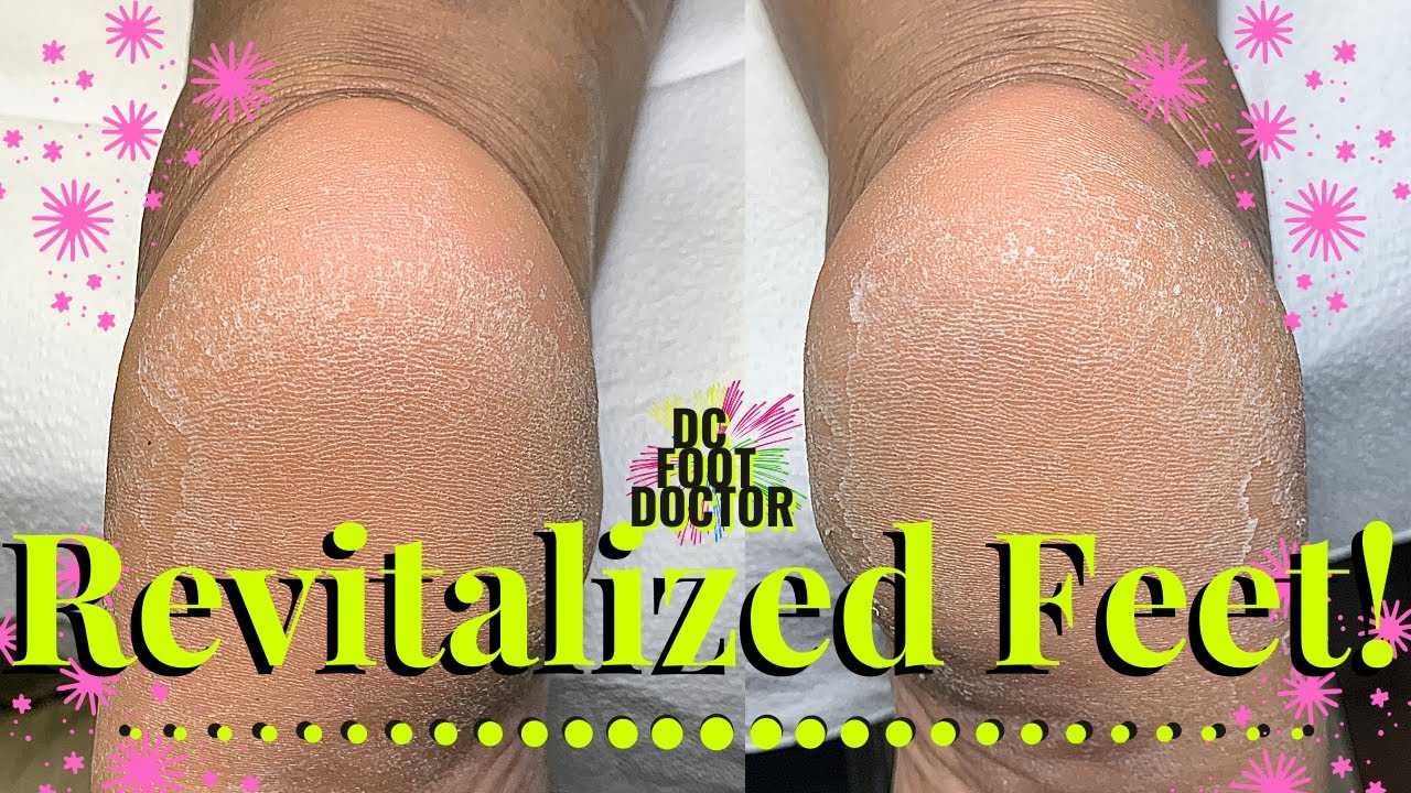 Revitalized Feet! Routine Maintenance for Healthy Callused Feet ...