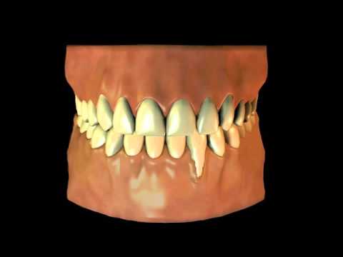 Autogenous Gingival Graft - YouTube