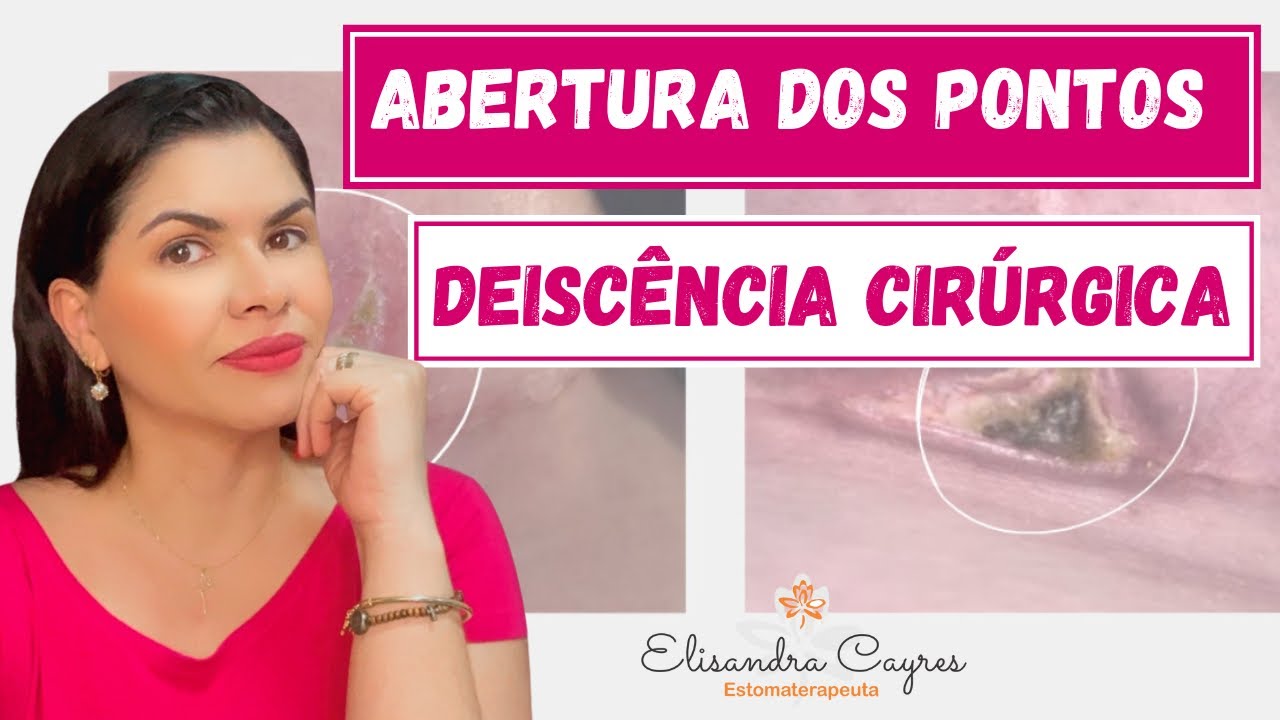 DEISCÊNCIA CIRÚRGICA - O QUE EU VENHO ENCONTRANDO… - YouTube