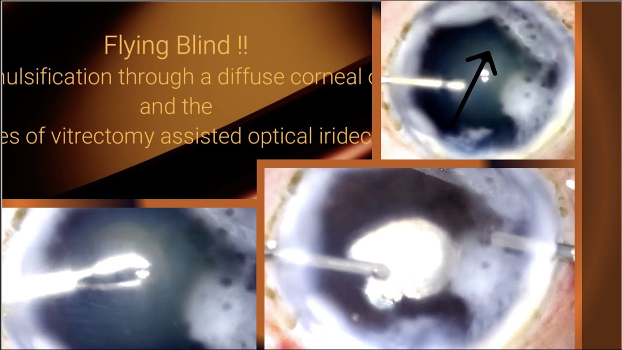 "Flying Blind"- Phaco through a diffusely hazy cornea and vitrectomy ...