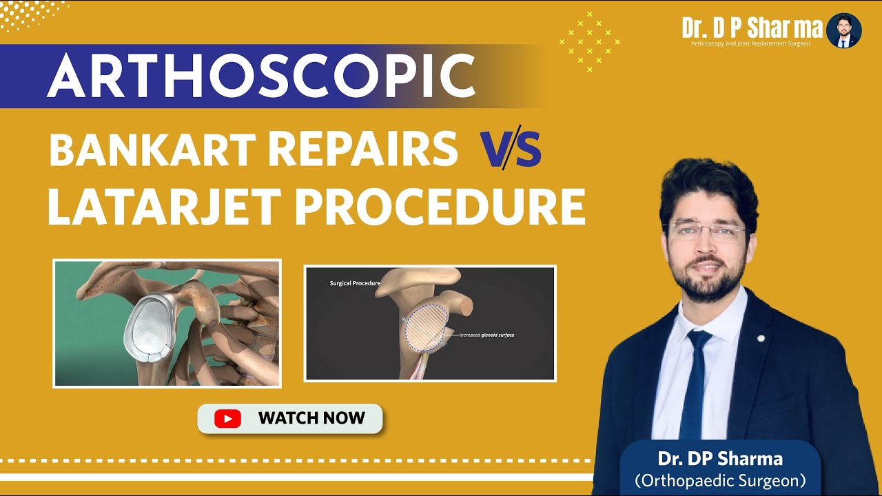 Difference Between Arthoscopic Bankart Repair & Laterjet Procedure ...
