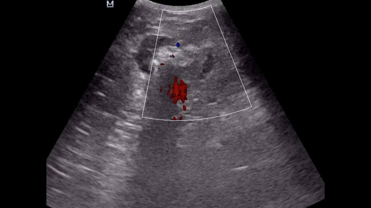 CASE 932 STRANGULATED PARAUMBILICAL HERNIA - YouTube