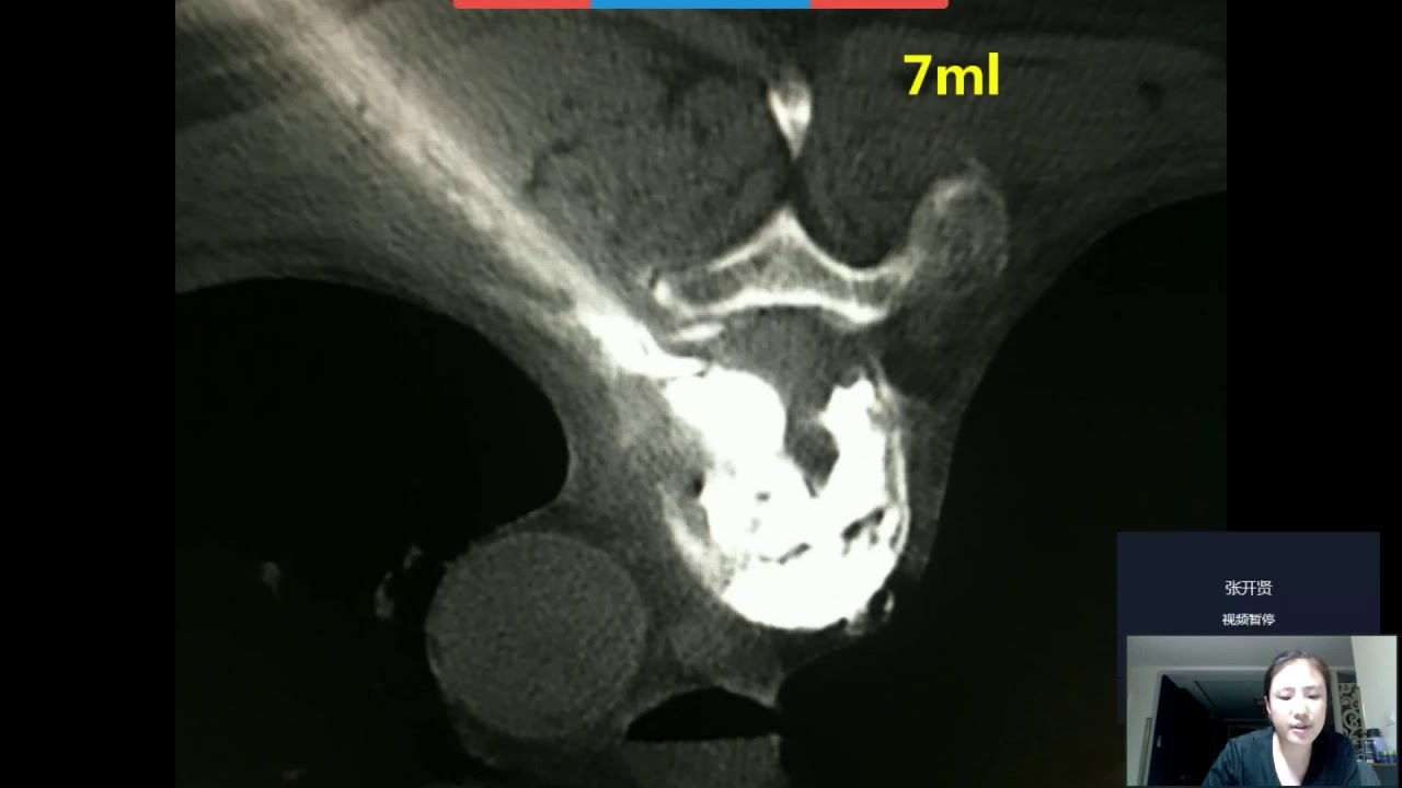 CCMA&SIO Webinar--MSK Interventional Oncology Prof Kai Xian Zhang - YouTube