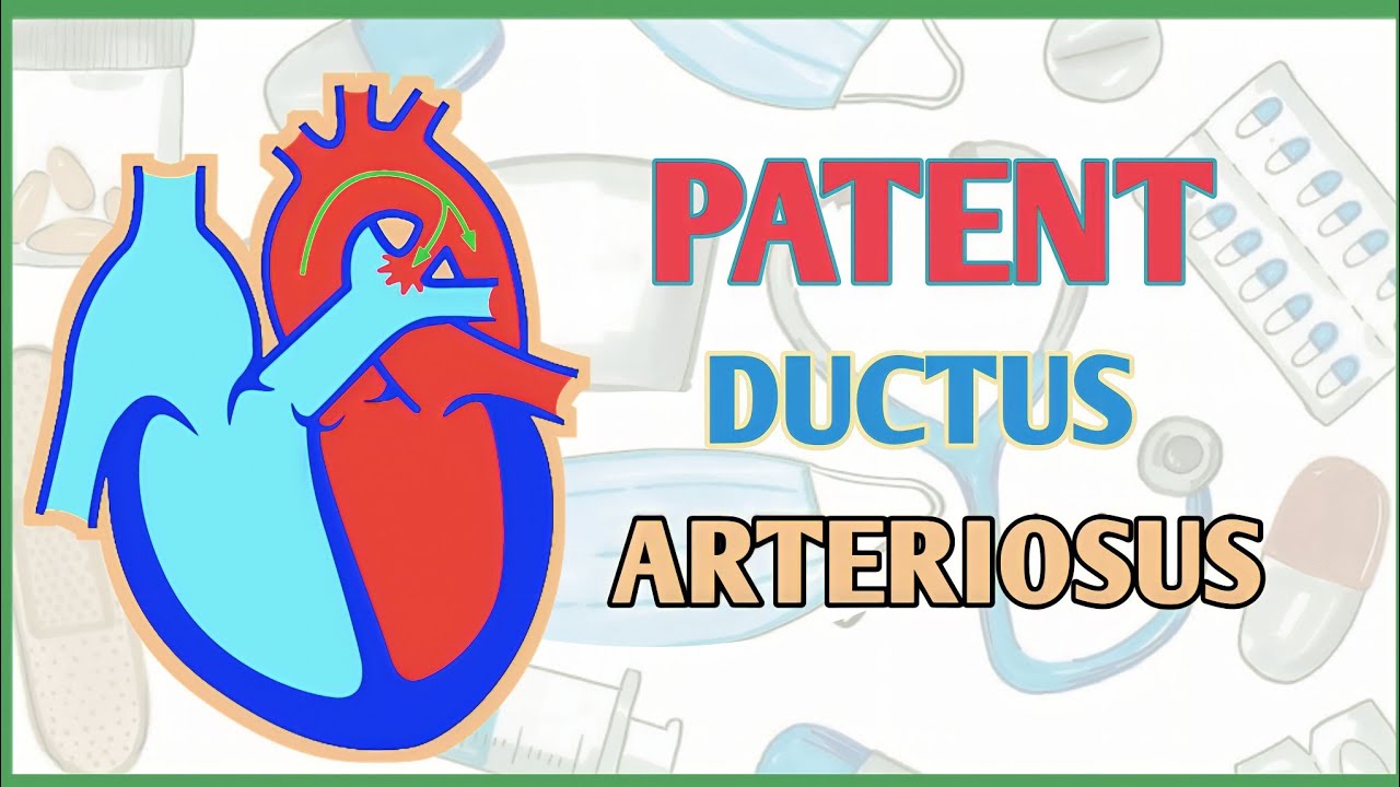 Patent Ductus Arteriosus Pda Pathophysiology Clinical Features