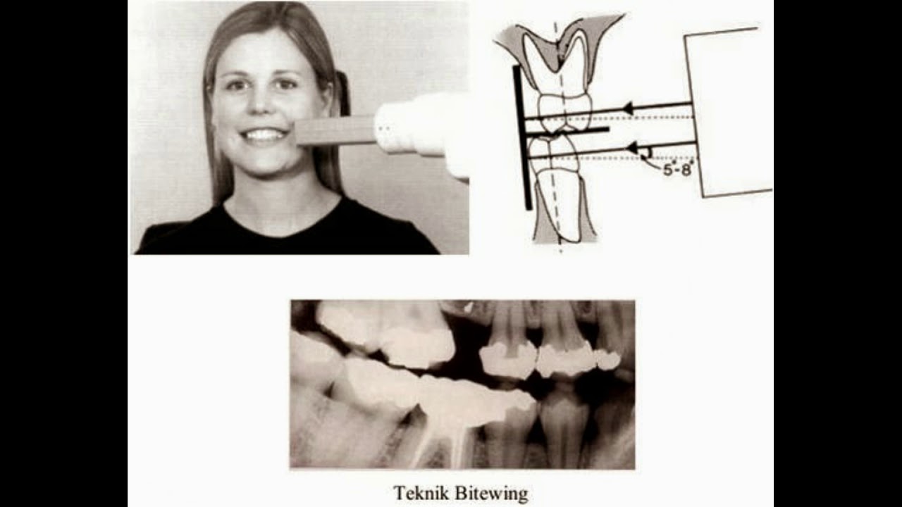 RADIOGRAFI BITEWING - YouTube