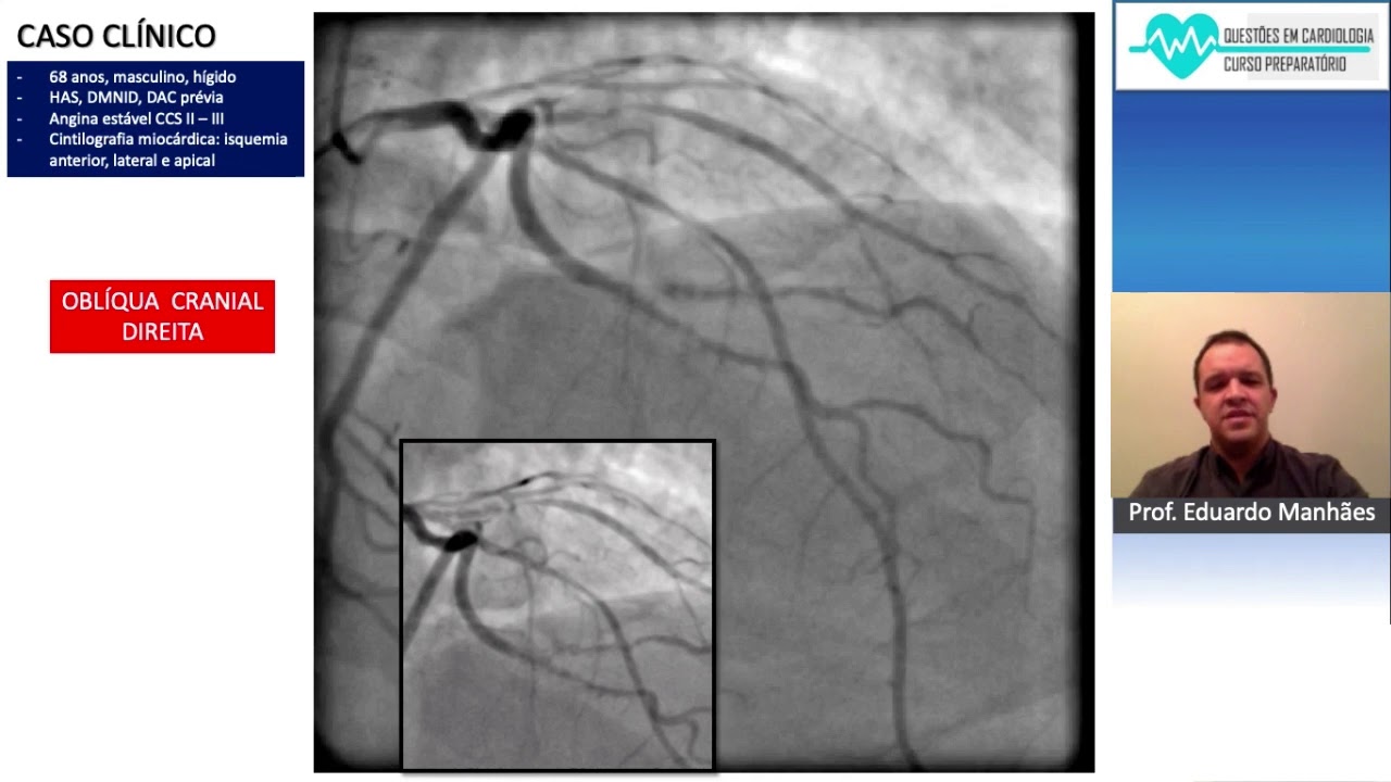 CASO CLÍNICO HEMODINÂMICA 1 - 68 anos, angina estável CCS II-III - YouTube