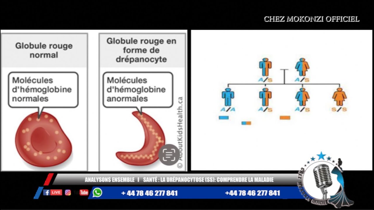 SANTÉ : LA DRÉPANOCYTOSE (SS): COMPRENDRE LA MALADIE - YouTube
