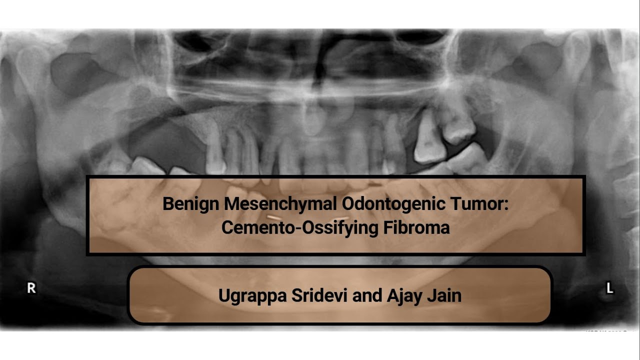 Cemento Ossifying Fibroma