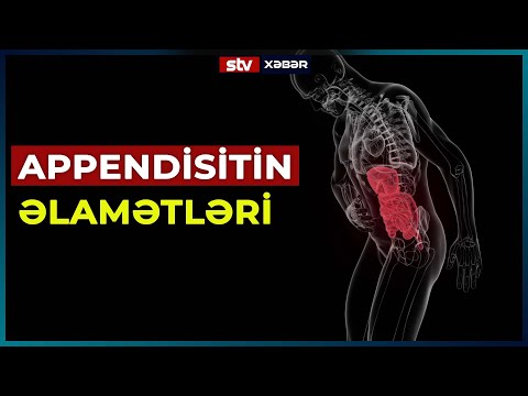 APPENDİSİTİN ƏLAMƏTLƏRİ - STV XƏBƏR