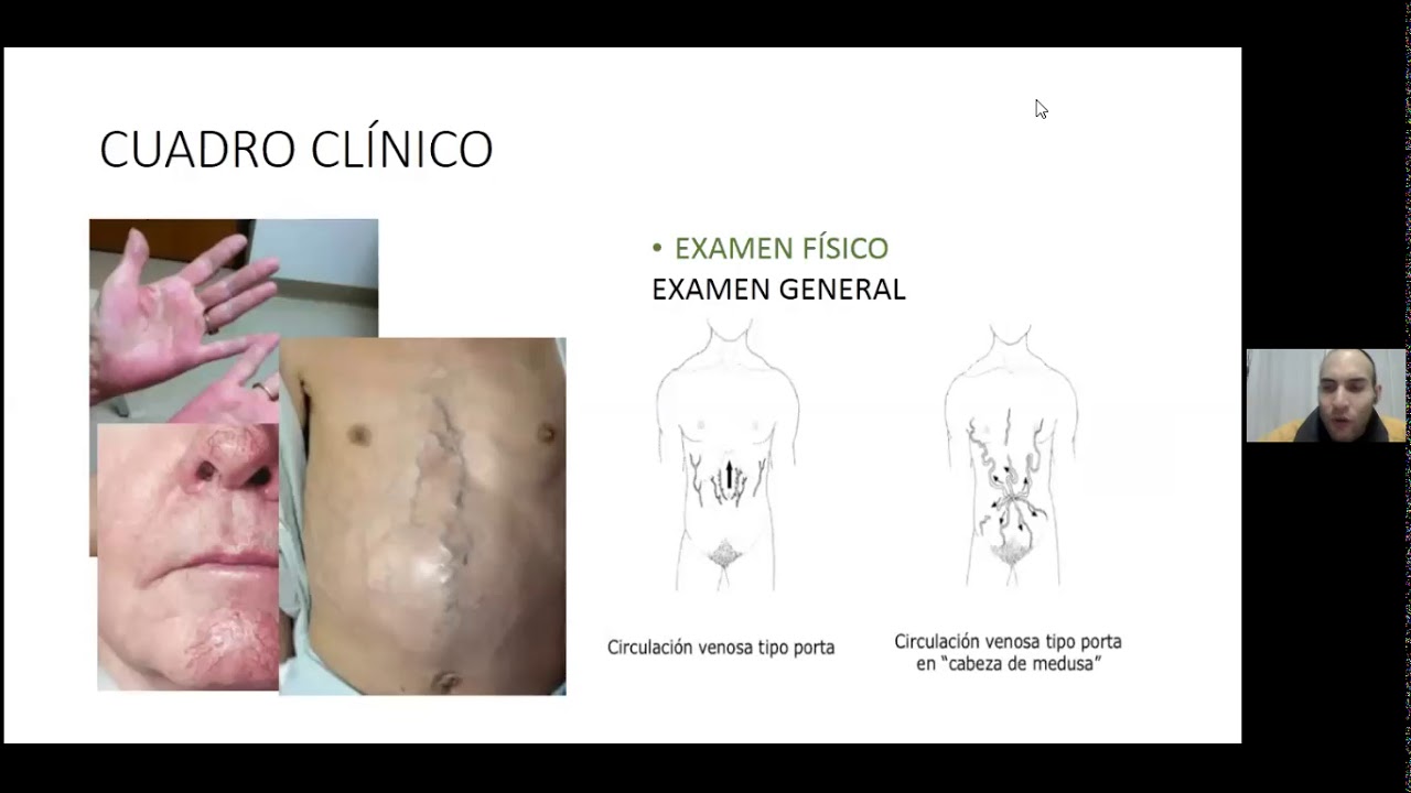 Síndrome Ascitico Edematoso 1/2 - YouTube