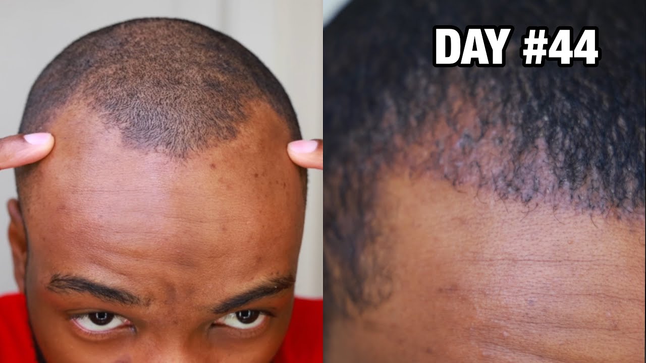 My Hairline Is Finally Growing In! - YouTube