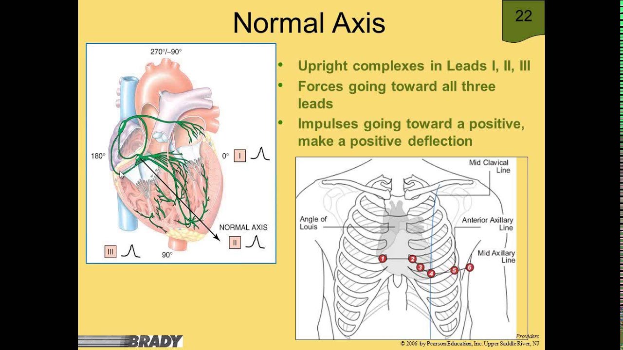 Axis Deviation In The 12 Lead ECG YouTube axis-deviation-in-the-12-lead-ecg-youtube