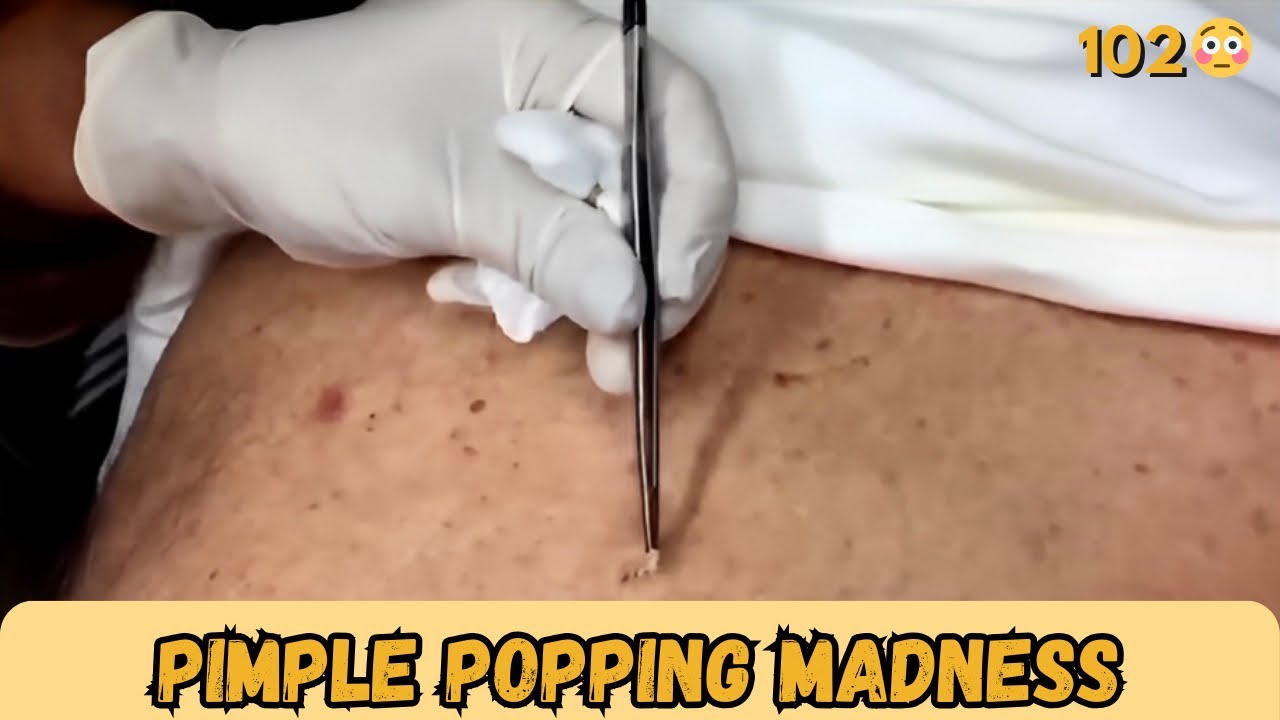 Ultimate Pimple Popping Compilation: Satisfying and Crazy Moments - YouTube