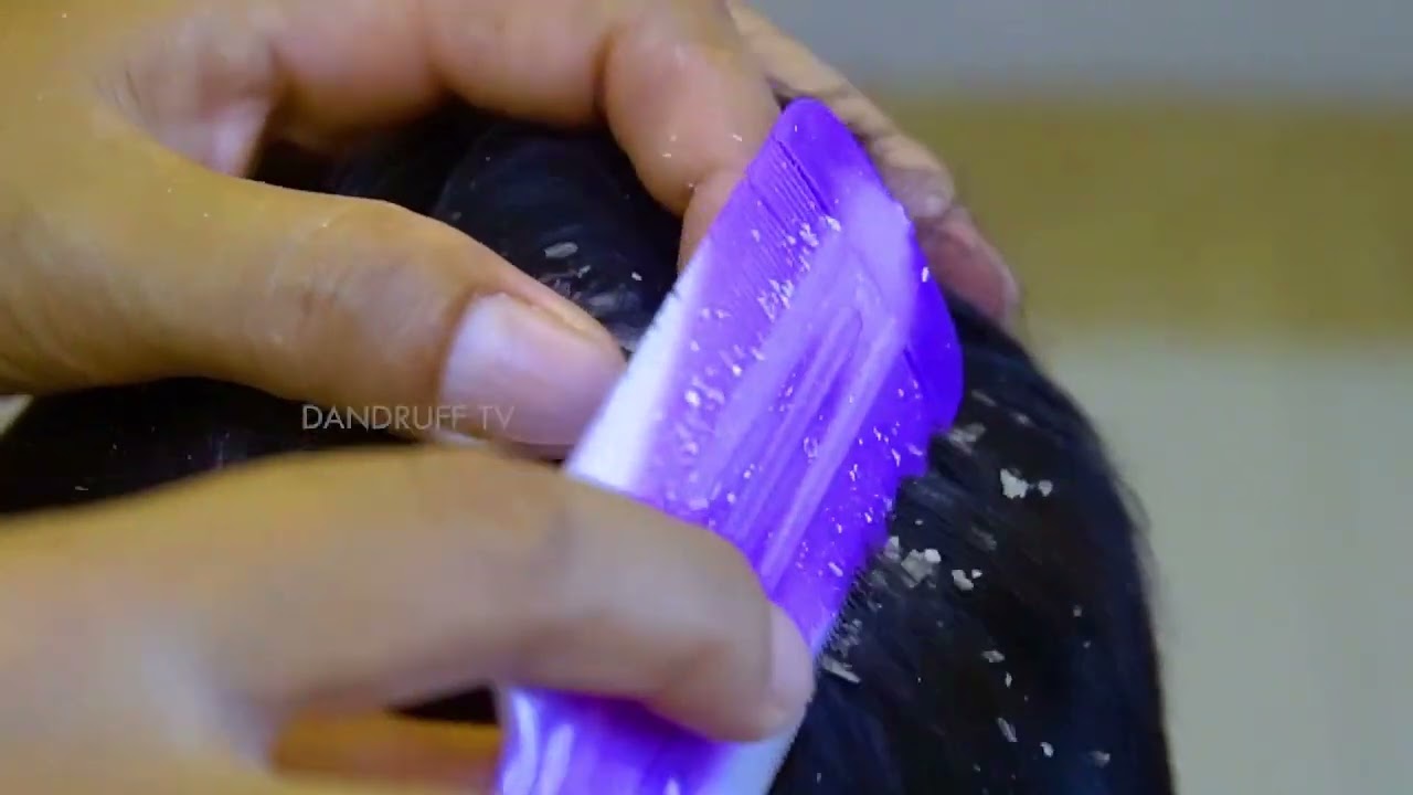 Quick Scratching Dandruff off scalp using simple way and Dandruff ...