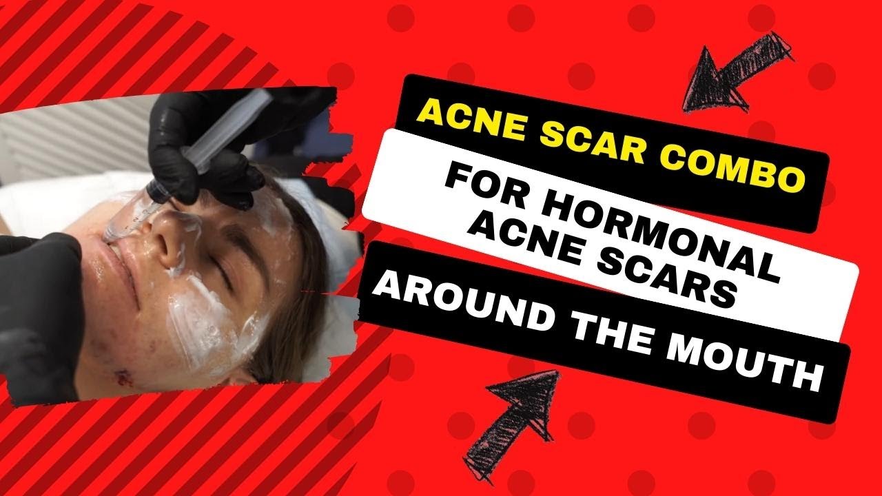 ACNE SCAR COMBO FOR HORMONAL ACNE SCARS AROUND THE MOUTH | PATIENT ...