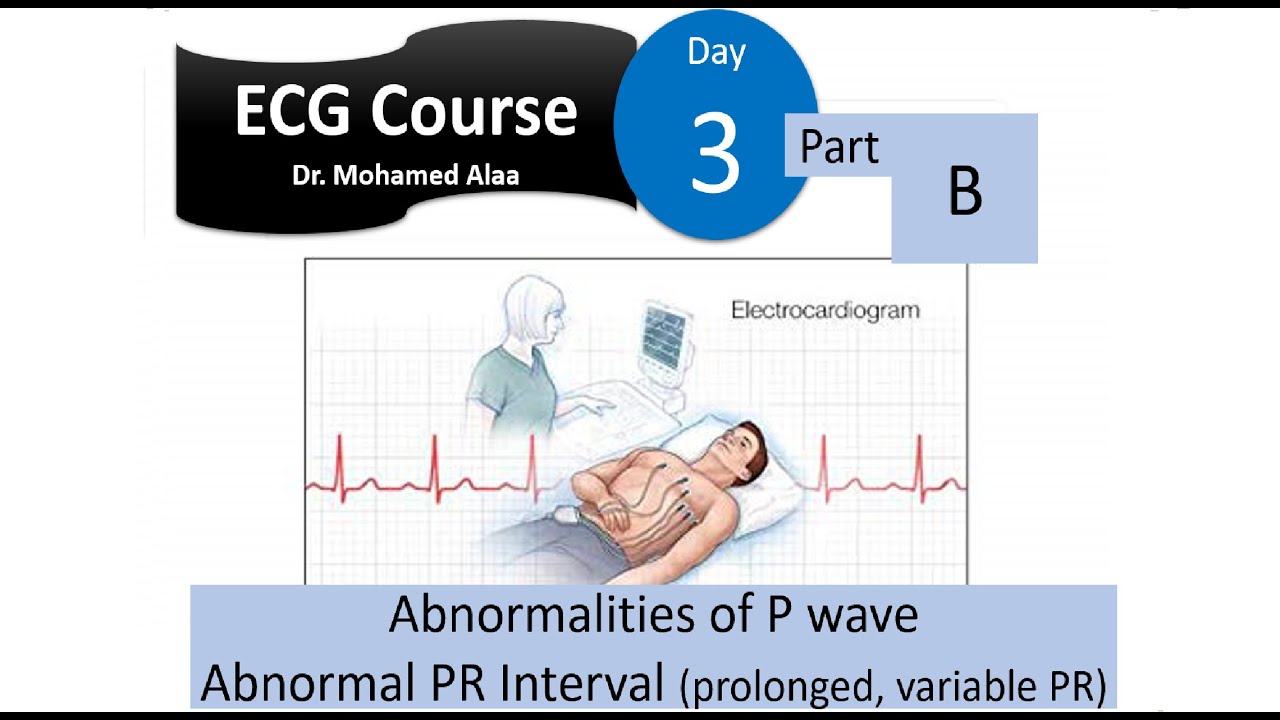 ECG course; Day (3); Part (B): Abnormalities of P wave and PR interval ...