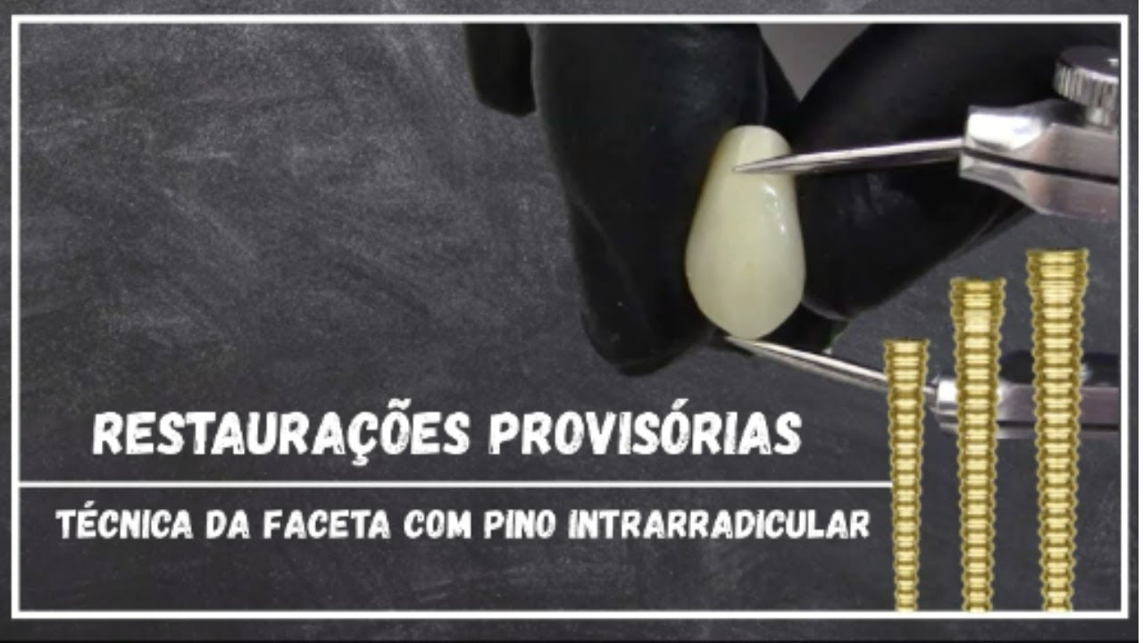Restauração Provisória: Técnica da faceta com pino intrarradicular ...