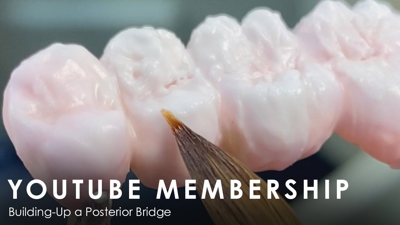 Building-Up a Posterior Bridge - YouTube