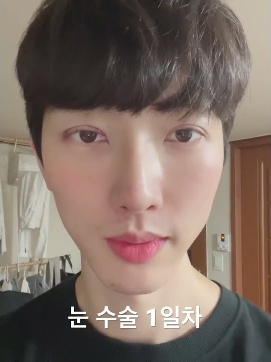 남자 쌍꺼풀수술 눈매교정 1일차 Youtube