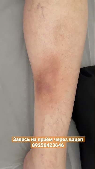 Варикоз лечение. Воспаление мягких тканей. Нарушение трофики. Узи ...