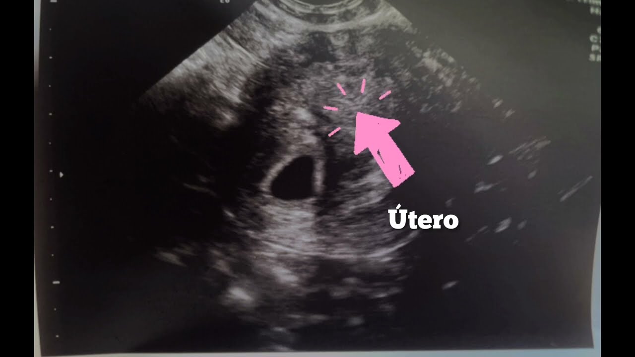 5 SEMANAS DE GESTACIÓN SACO GESTACIONAL SIN EMBRIÓN - YouTube