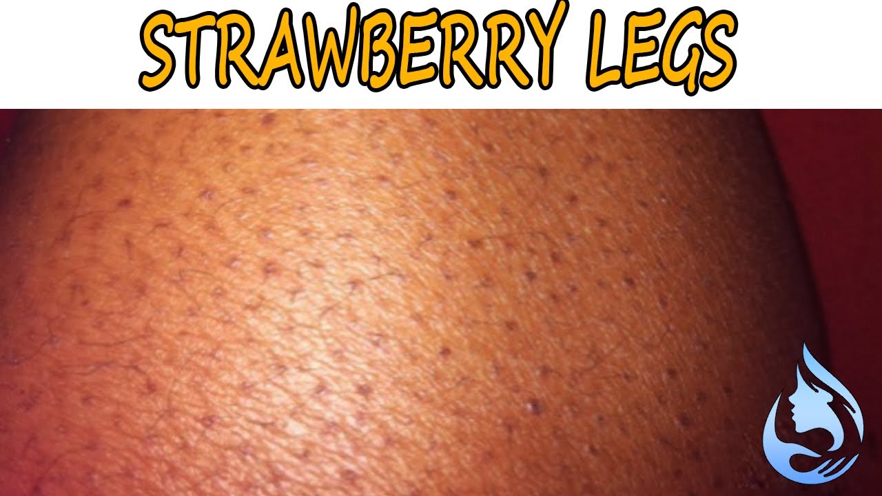 How to Get Rid of Strawberry Legs - YouTube