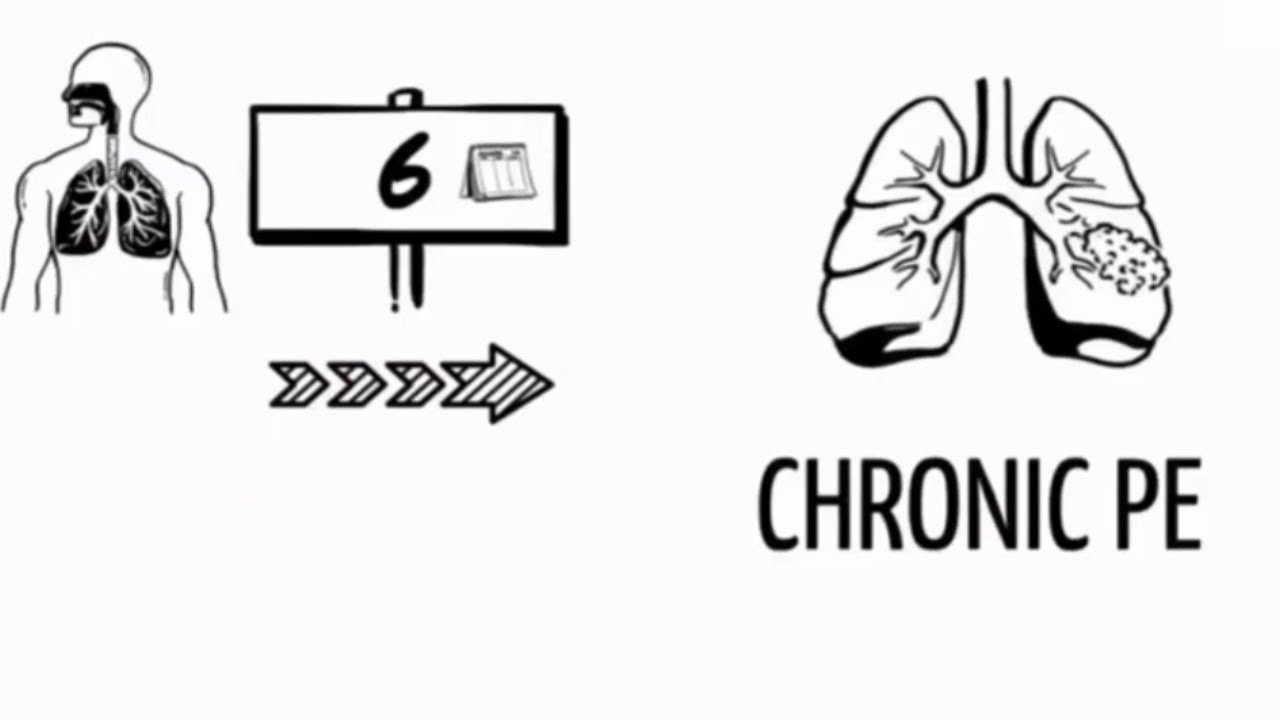 Pulmonary Embolism (PE) Explained: Understanding the Basics and Types ...