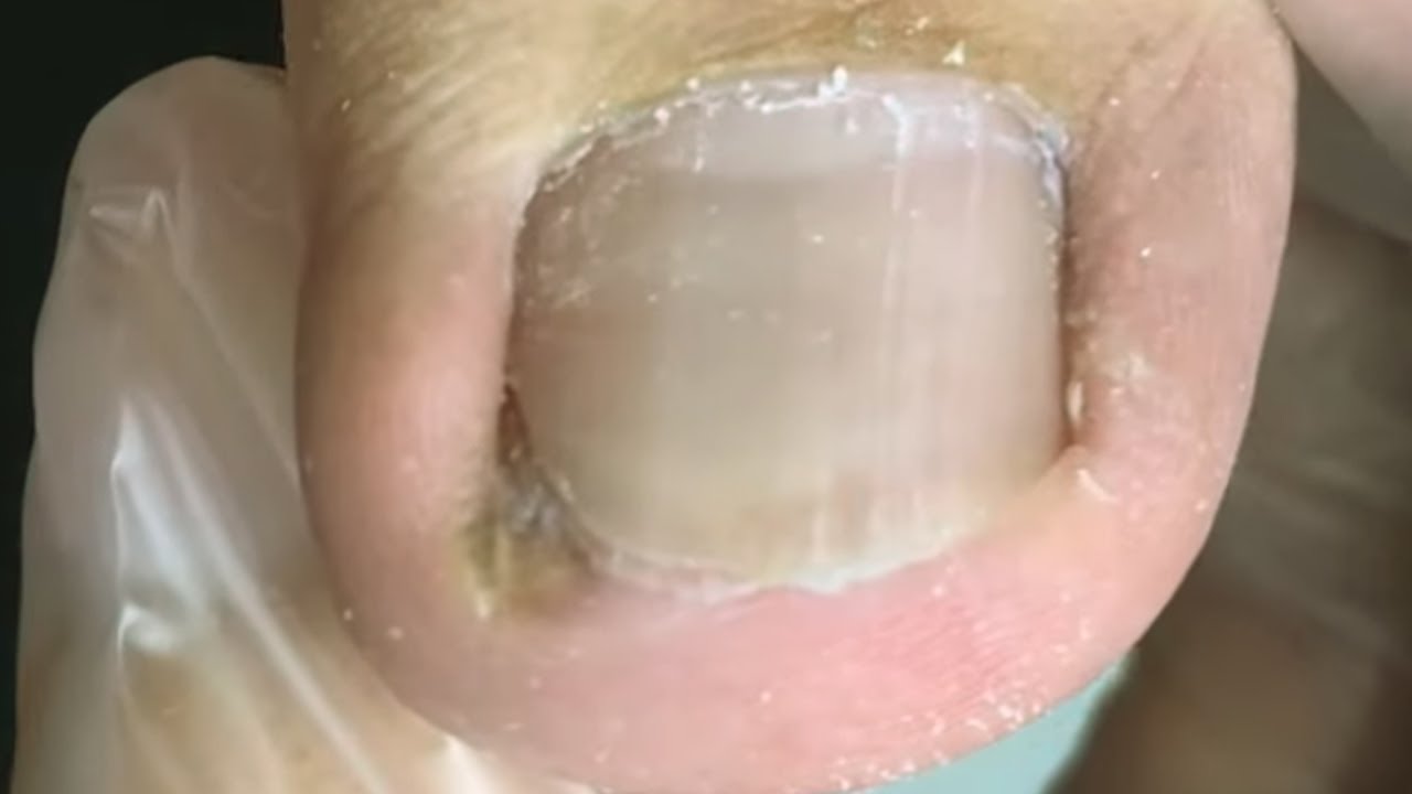 Inflamed nails! Dig out the hidden ingrown armor【Dr. Zhang】 - YouTube