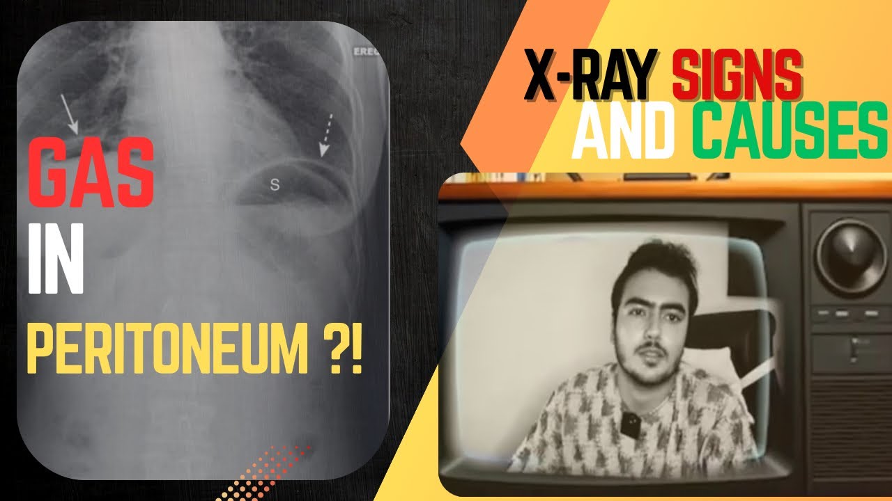 Pneumoperitoneum on X-Ray | How to Recognize Free Air & Understand Its ...
