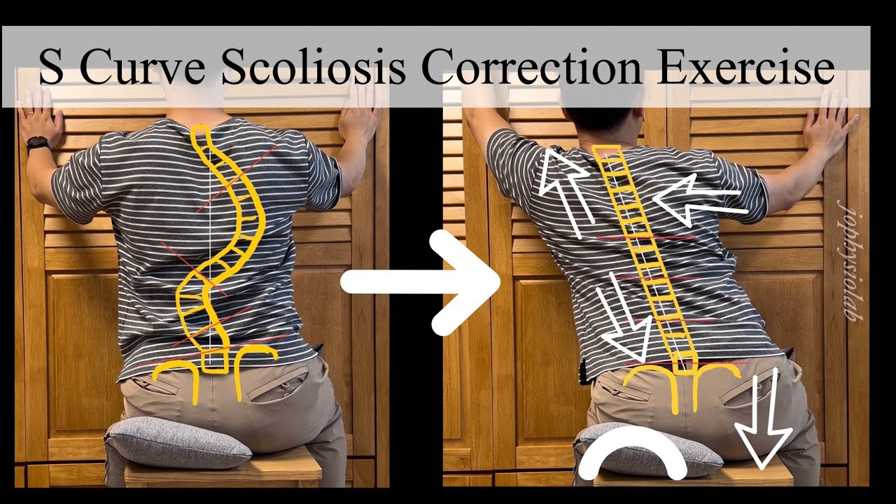 Scoliosis Double Curve Scoliosis Correction Exercise In Sitting S