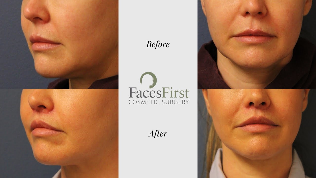 Lip Lift | FacesFirst - YouTube